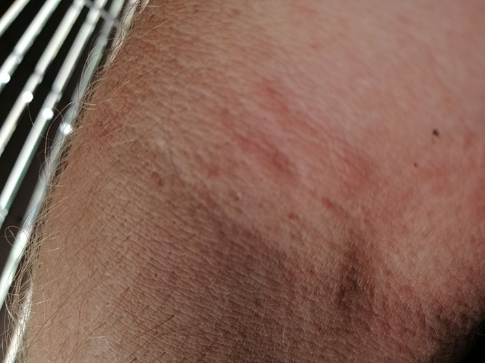 Urticaria y alergia por marihuana | Blog de Marihuana El Cogollo