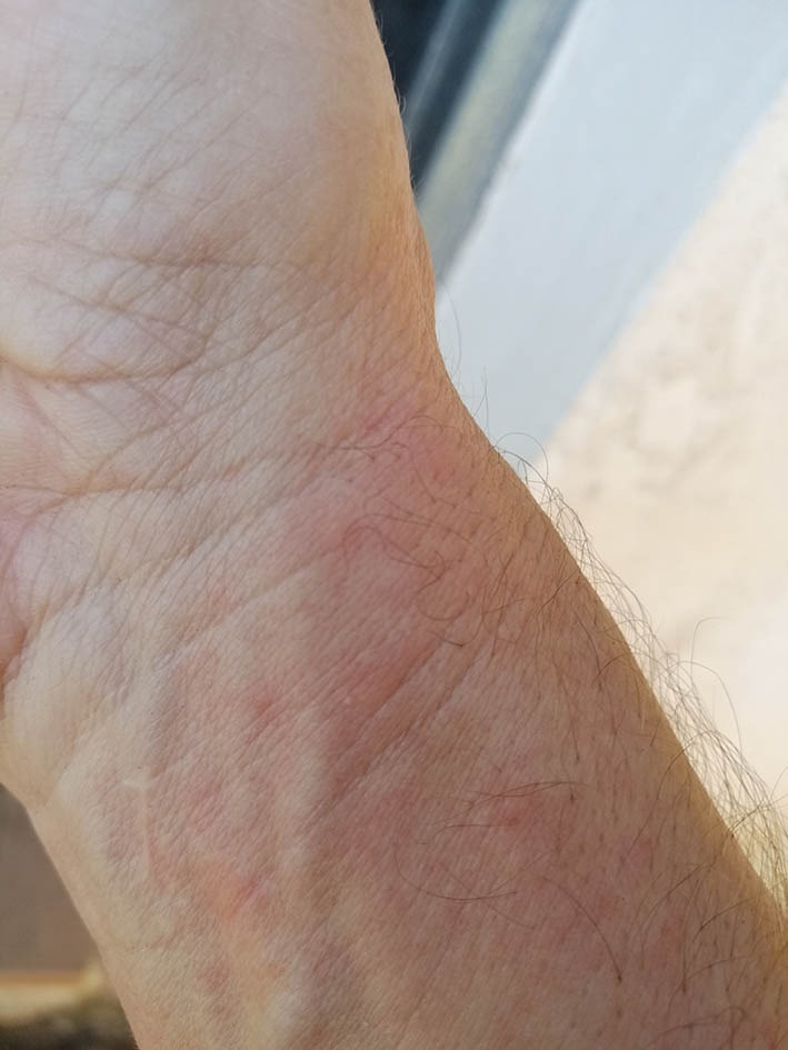 Urticaria y alergia por marihuana | Blog de Marihuana El Cogollo